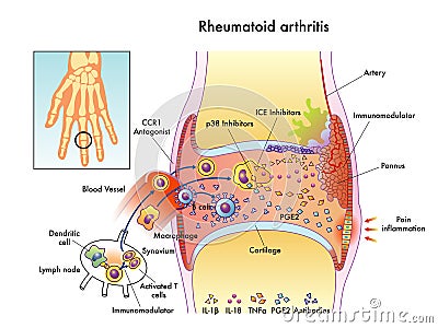 Rheumatoid Arthritis Stock Photo - Image: 21840850