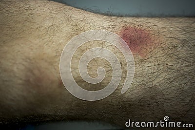Right Leg Abscess In Male Patient Stock Photo | CartoonDealer.com ...