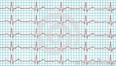 Ritmo Sinusale Normale Del Cuore Sull'elettrocardiogramma Fotografie ...