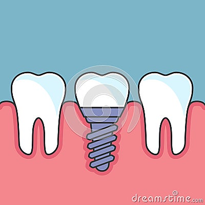 Row Of Teeth With Dental Implant - Prosthetics Vector Illustration ...