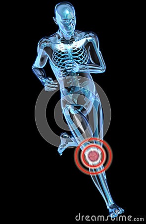 Running Man Seen By X-ray With Knee Pain Royalty-Free Stock Photography ...