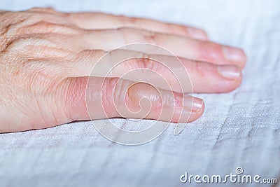 Scalded Hand. Blister On Your Finger. Stock Photo - Image: 76272749