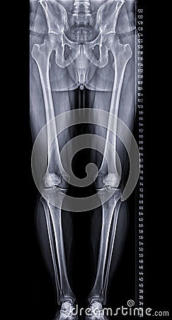 Scanogram Is A Full-length Standing AP Radiograph Of Both Lower ...
