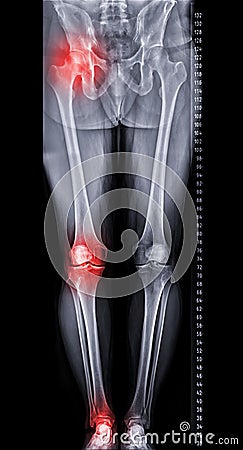 Scanogram Is A Full-length Standing AP Radiograph Of Both Lower ...