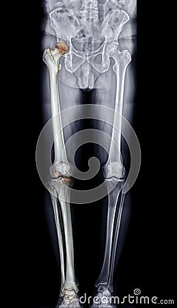 Scanogram Is A Full-length Standing AP Radiograph Of Both Lower ...