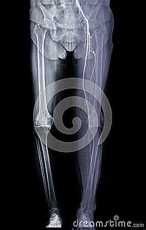 Scanogram Image Fusion With CTA Lower Extremities Royalty-Free Stock ...