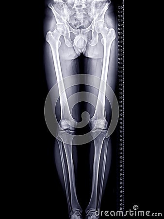 Scanogram Of Lower Limb Or X-ray Image Of Total Lower Extremity With ...