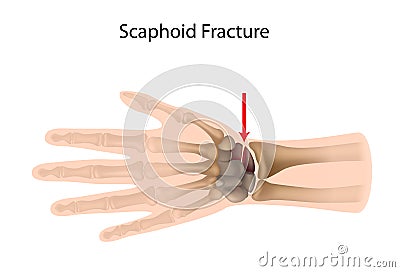 Scaphoid Wrist Fracture Stock Photos - Image: 28181323