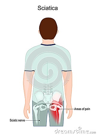 Sciatica. Areas Of Pain. Sciatic Nerve Cartoon Vector | CartoonDealer ...