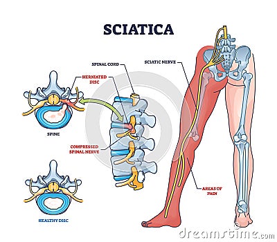 Sciatica As Symptom From Herniated Disc And Spinal Nerve Outline ...