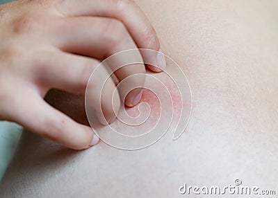Scratching Insect Flea Bite Body Chest Foot By Hand Itch Stock Image ...