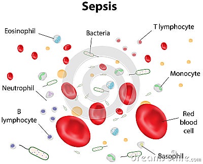 Sepsis Cartoon Vector | CartoonDealer.com #42214737