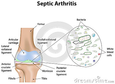 Septic Arthritis Stock Vector - Image: 42214736