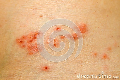 Shingles Rash Stock Photos - Image: 28588363