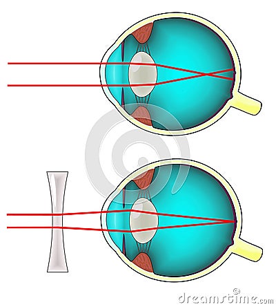 Shortsighted Eye Diagram Stock Images - Image: 9572504