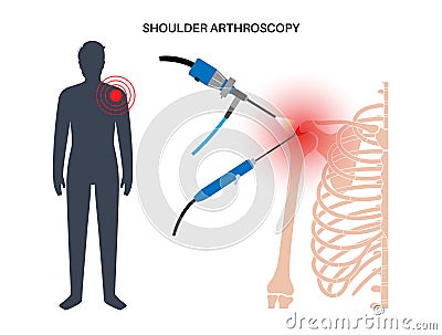 Shoulder Arthroscopy Poster Cartoon Vector | CartoonDealer.com #286360529