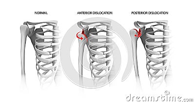 Shoulder Dislocation Options Stock Illustration | CartoonDealer.com ...