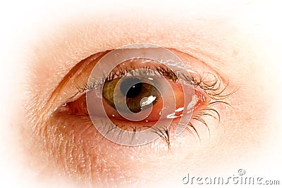Sick Eye With Conjunctivitis Royalty Free Stock Photos - Image: 15540728