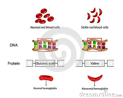 Sickle Cell Anemia, Disease. Normal And Sickled Red Blood Cells. Stock ...