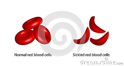 Sickle Cell Anemia, Disease. Normal And Sickled Red Blood Cells. Vector ...