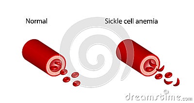 Sickle Cell Anemia, Disease. Normal And Sickled Red Blood Cells ...