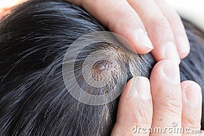 Skin Disease On The Head Stock Photo - Image: 66892151