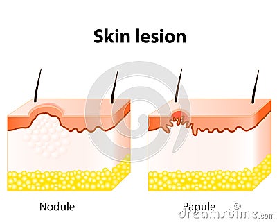 Skin Lesion Cartoon Vector | CartoonDealer.com #65032655