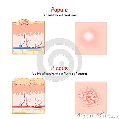 Skin Lesion. Papule And Plaque. Side And Top View. Cross Section Of The ...