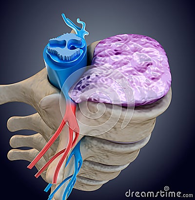 Spinal Cord Under Pressure Of Bulging Disc. Medically Accurate ...