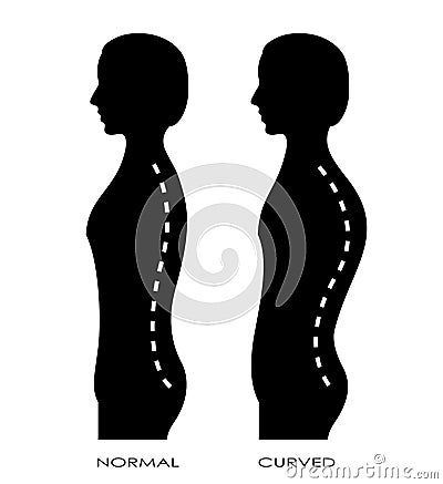 Spinal Curvature Vector Illustration | CartoonDealer.com #53215486