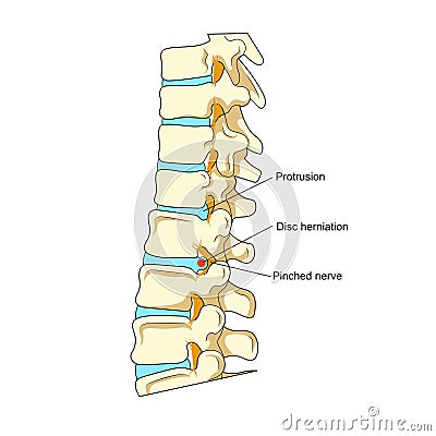 Spinal Disc Herniation Diagram Medical Science Vector Illustration ...