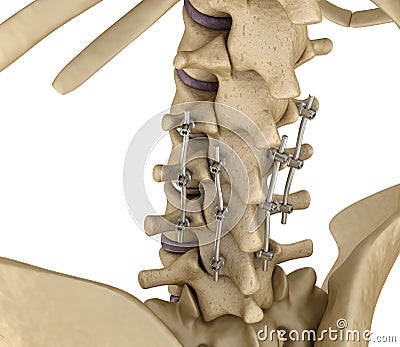 Spinal Fixation System - Titanium Bracket. Medically Accurate Royalty ...