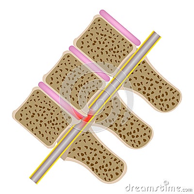 Spinal Stenosis. Destruction Of The Vertebra And Intervertebral Disc ...