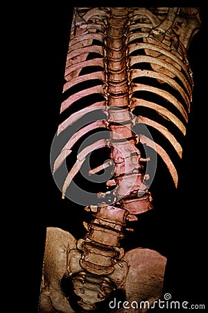 Dramatic Spine, Ribs Fracture. CT-scan Reconstruction. Stock Image ...