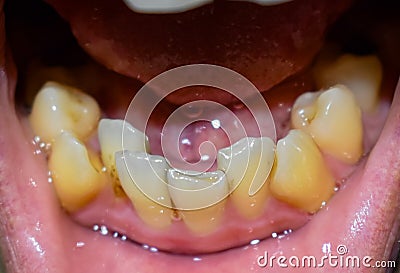 Stacked Or Overlapping Teeth Of Asian Man. Also Called Crowded Teeth ...