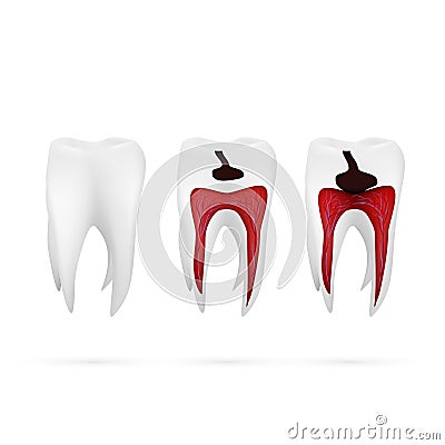 Stages Of Caries Development Isolated On White Vector Illustration ...