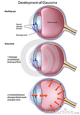Stages Of Glaucoma Stock Image - Image: 19891451