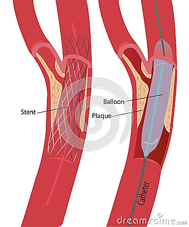 Angioplasty, Endovascular Surgery. Stent, Balloon, Medical Illustration ...