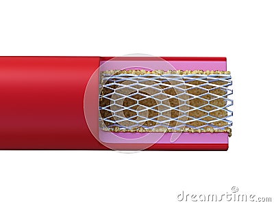 Stent Placed In An Artery Royalty-Free Illustration | CartoonDealer.com ...