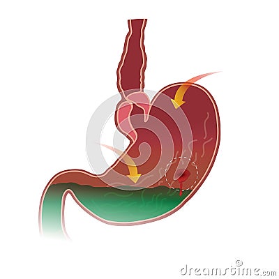 Stomach Peptic Ulcer. White Background Isolate. Cartoon Vector ...
