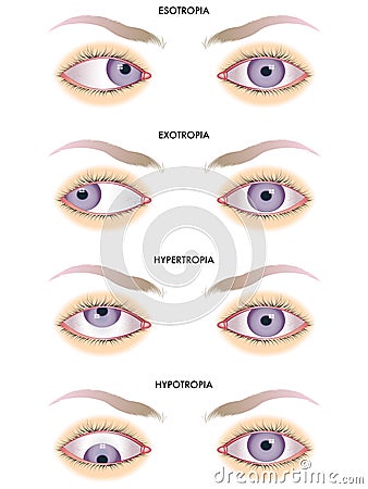 Strabismus Stock Image - Image: 28300621