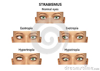 Strabismus, Eyes Deviation, Illustration | CartoonDealer.com #208730010