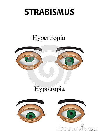 Strabismus. Hypertropia. Hypotropia. Infographics. Vector Illustration ...