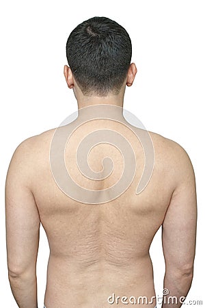 Stretch Scars On Male Back Royalty Free Stock Photography - Image: 19346687