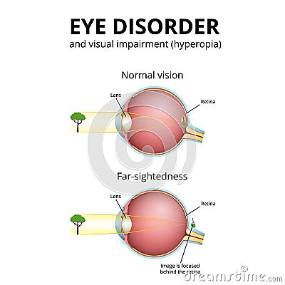 Structure Of The Eyeball, Visual Impairment, Farsightedness Cartoon ...