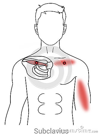 Subclavius: Managing Chest And Arm Pain Originating From Myofascial ...