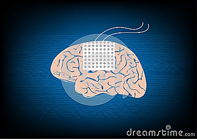 Subdural Electrode For Brain Waves Monitoring In Epilepsy Surgery ...
