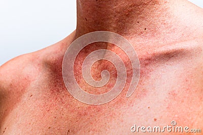 Sun Allergy Royalty Free Stock Photo - Image: 28453295