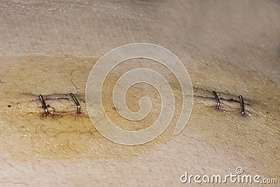 Surgical Incisions In The Abdomen After Laparoscopy For Cholecystectomy ...
