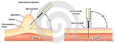 Techniques Sous-cutanées Et D'injection Intramusculaire Illustration de ...